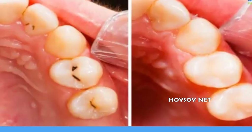 ¿Qué son las caries? Revista Digital